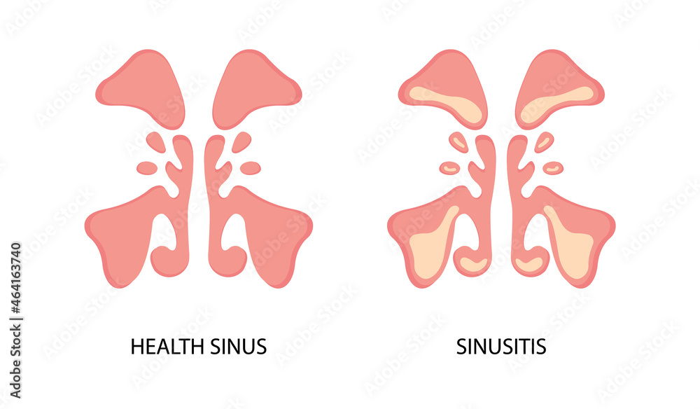 Healthy sinus and sinusitis flat image. Infection, inflammation, nasal ...