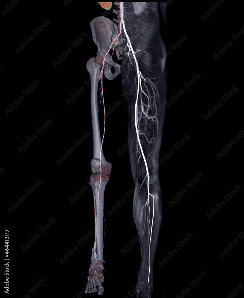 Compare CTA femoral artery run off and Magnetic resonance angiography ...