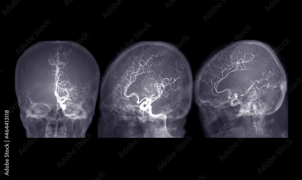 Cerebral angiography AP,Oblique and Lateral view image from Fluoroscopy ...