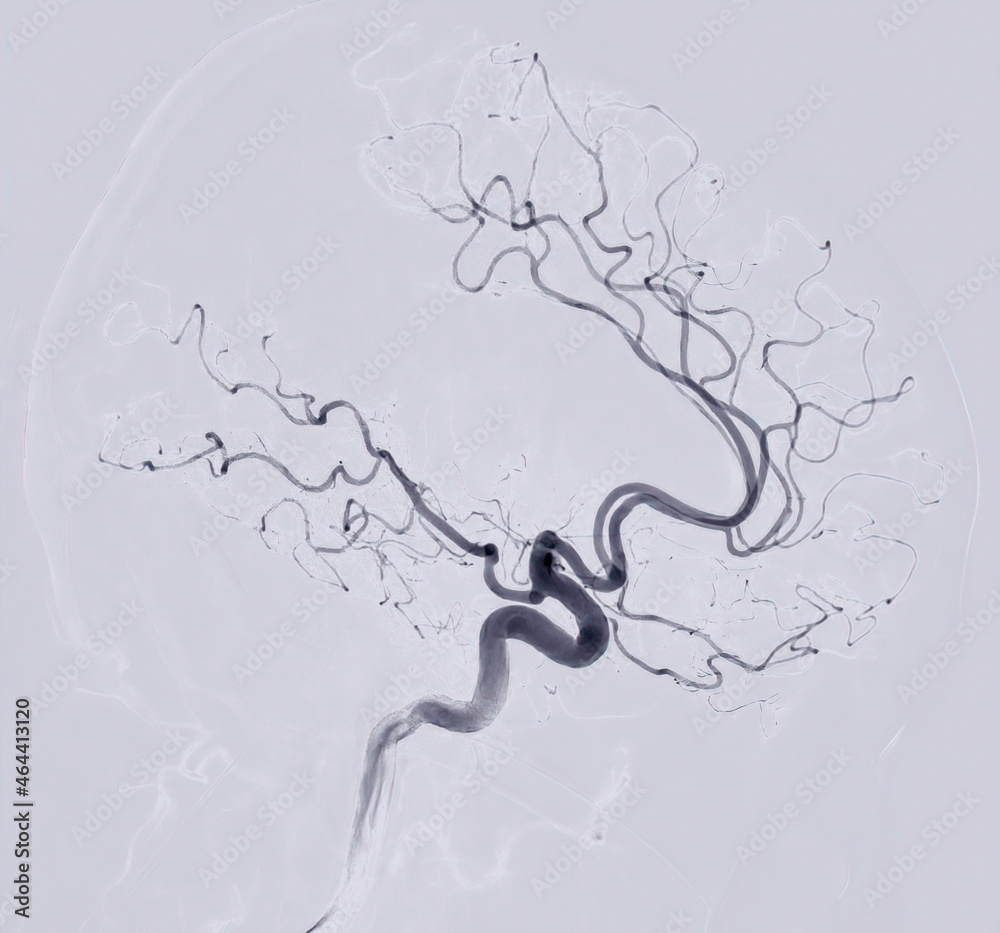 Cerebral angiography Lateral view image from Fluoroscopy in ...
