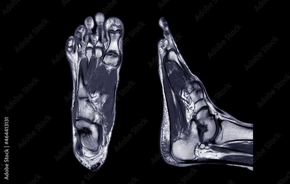 Manetic resonance imaging of foot or MRI FOOT PDW axial, Coronal and ...