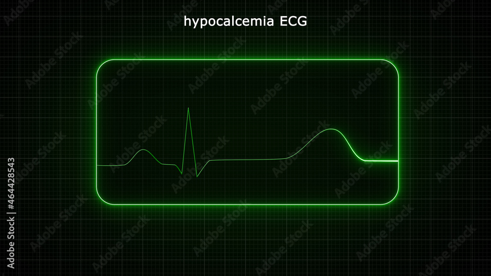 ECG changes in Hypocalcaemia · Hypocalcaemia causes QTc prolongation ...