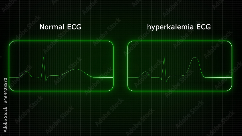 Hypokalemia is when blood's potassium levels are too low. Potassium is ...