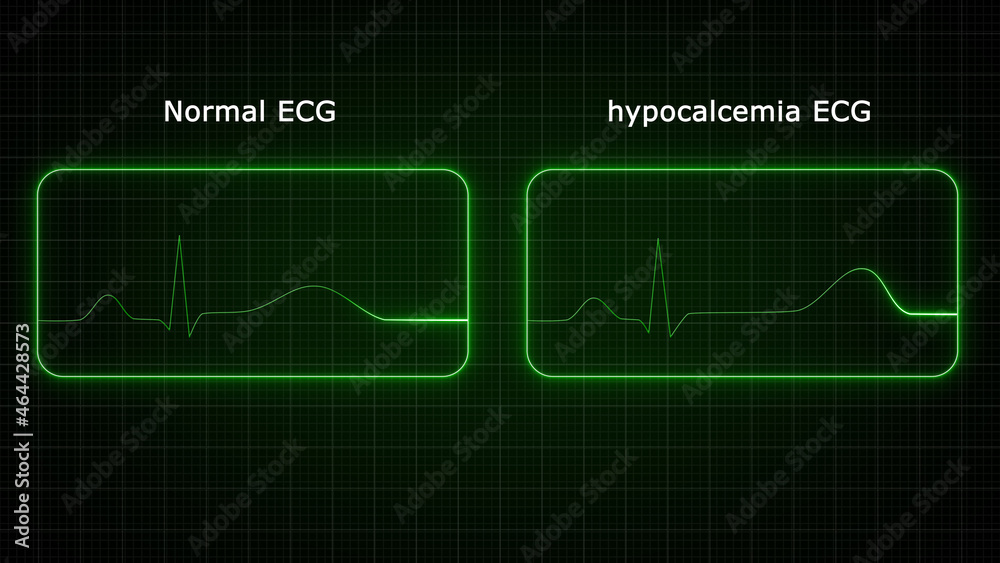 The ECG hallmark of hypocalcemia remains the prolongation of the ...