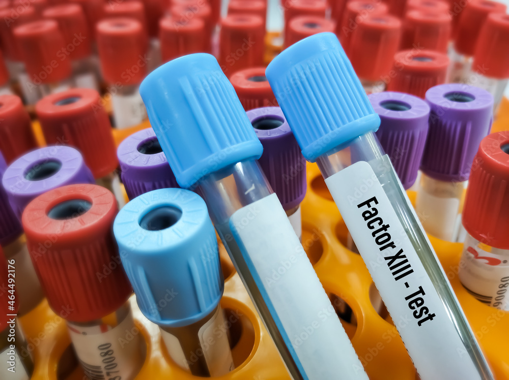 Blood sample for Factor XIII or fibrin stabilizing factor test ...