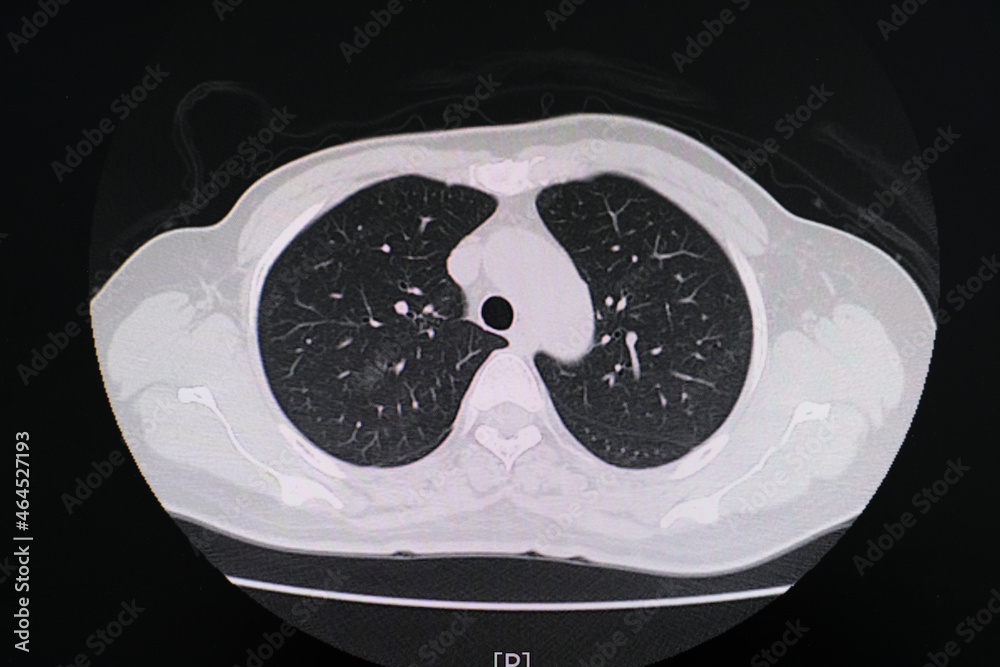 CT scan (computed tomography) of chest organs. Stock Photo | Adobe Stock