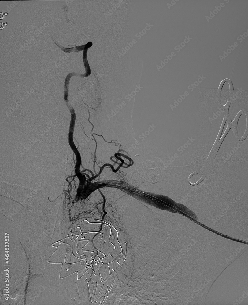 vascular angiogram was performed subclavian artery and common carotid ...