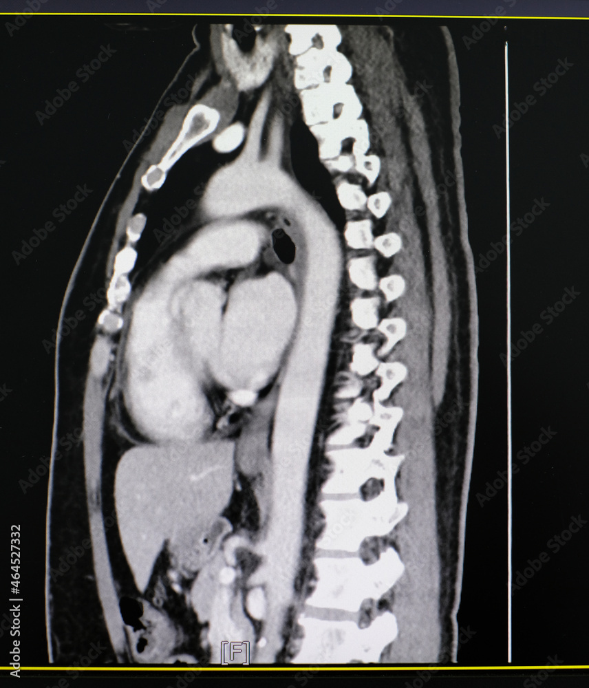 CT scan (computed tomography) of chest and abdominal organs. Stock ...