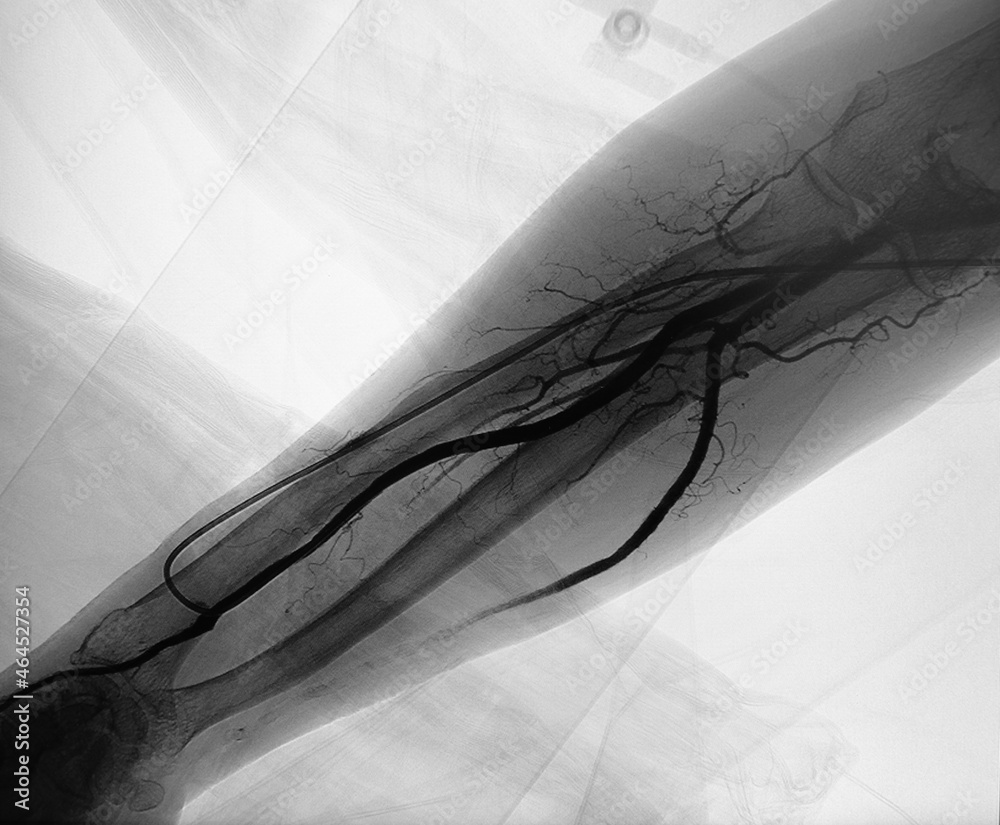The preoperative evaluation consisted of angiogram of the radial artery ...