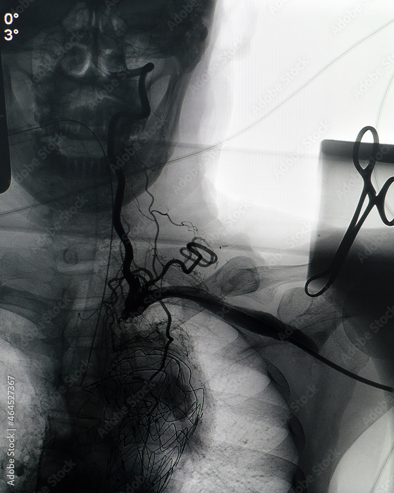 vascular angiogram was performed subclavian artery and common carotid ...