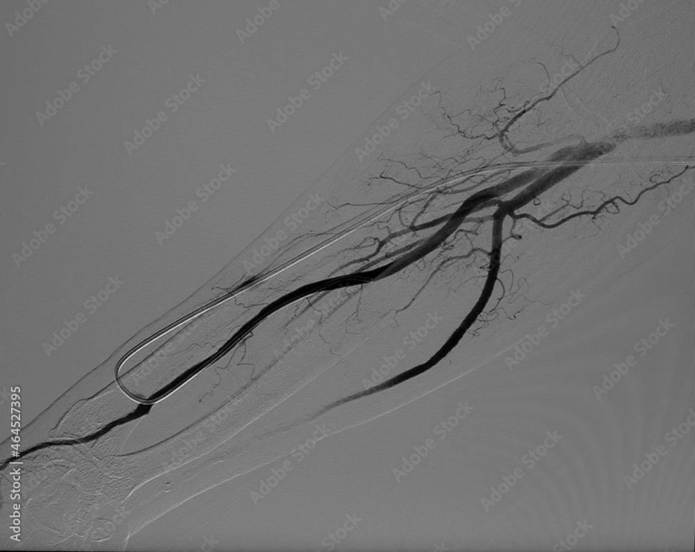 The preoperative evaluation consisted of angiogram of the radial artery ...