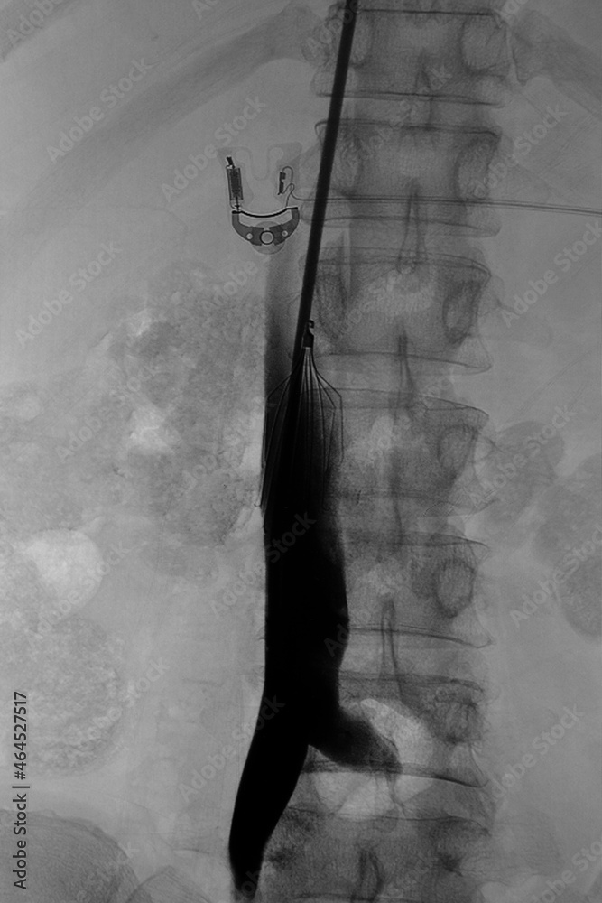 Vascular angiogram was perform contrast media flow through inferior ...