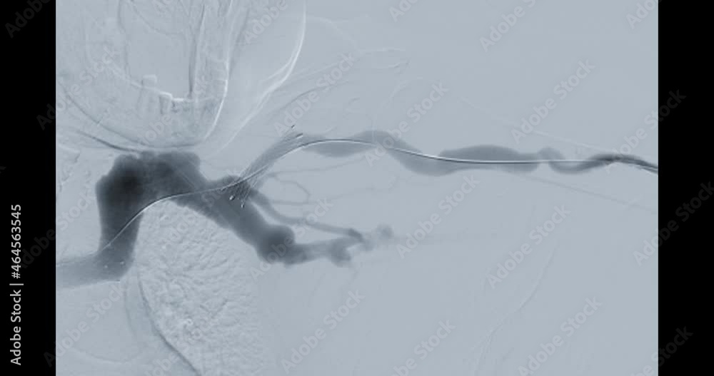 Percutaneous transluminal angioplasty or PTA of the arteries of the arm ...