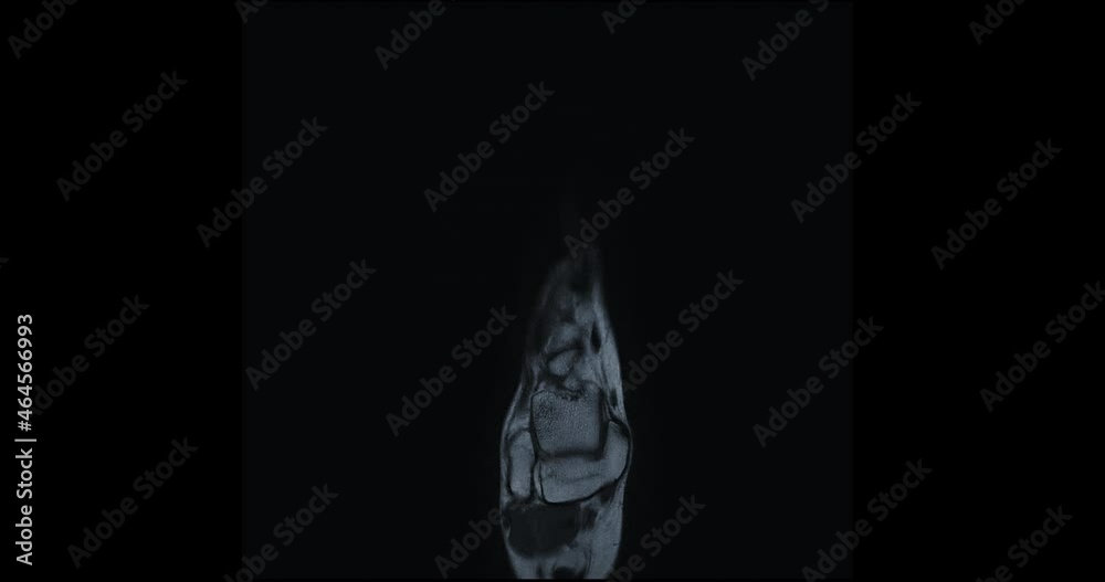 MRI FOOT Coronal PDW for diagnostic tendon of foot injury. Stock ビデオ ...