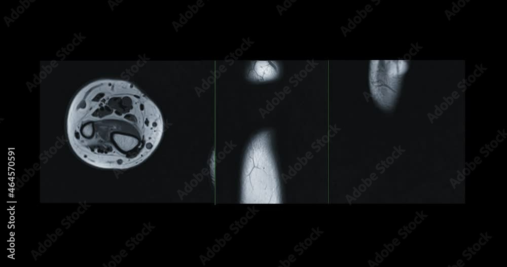 MRI wrist joint Axial , coronal and sagittal viewPDW For diagnosis ...