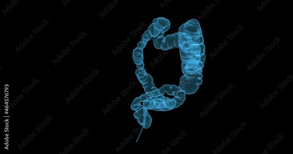 CT colonography 3D rendering for screening colorectal cancer. Check up ...