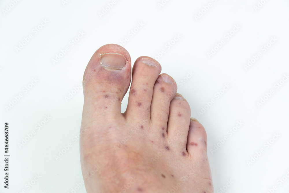 Painful rash, red blisters on a man's leg. Human leg with dermatitis ...