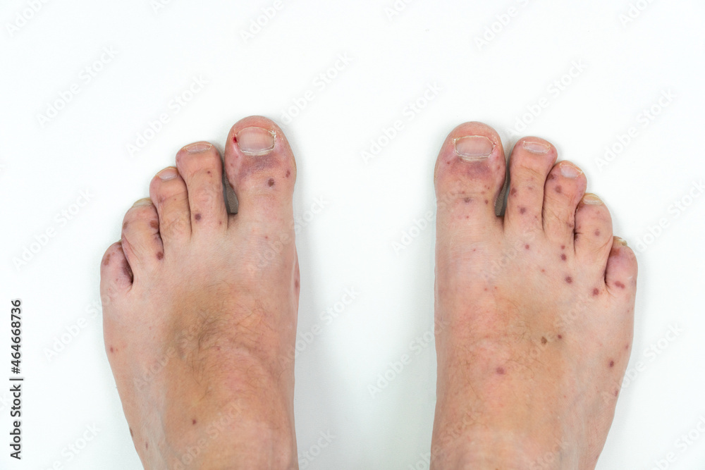 Human legs with dermatitis, allergy rash. Close up of male's foot and ...