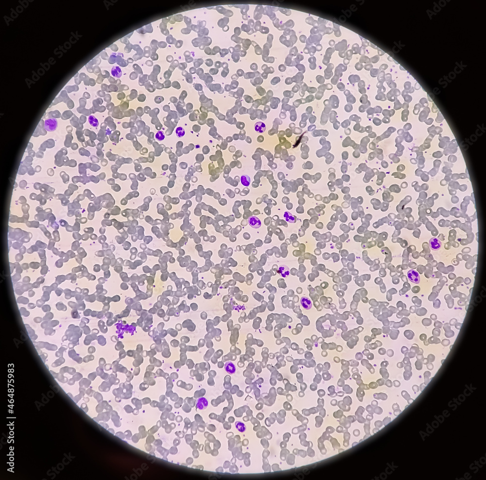 Essential thrombocytosis blood smear, present abnormal high platelet ...