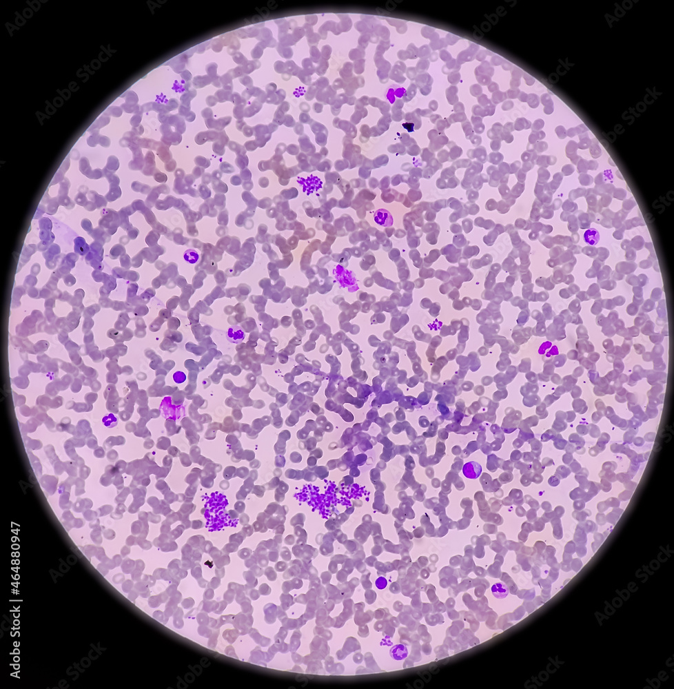 Fototapeta Thrombocythemia, Essential thrombocytosis blood smear ...