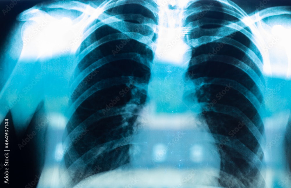 Chest radiography, lung x-ray after a covid 19 infection Stock Photo ...