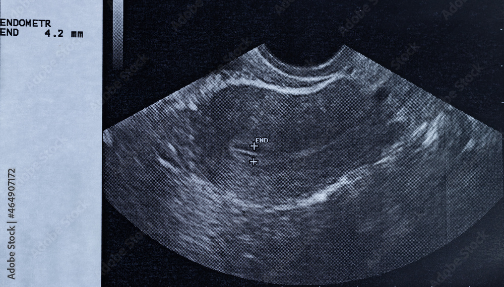 Ultrasound of a woman's uterus showing the size of the endometrium ...