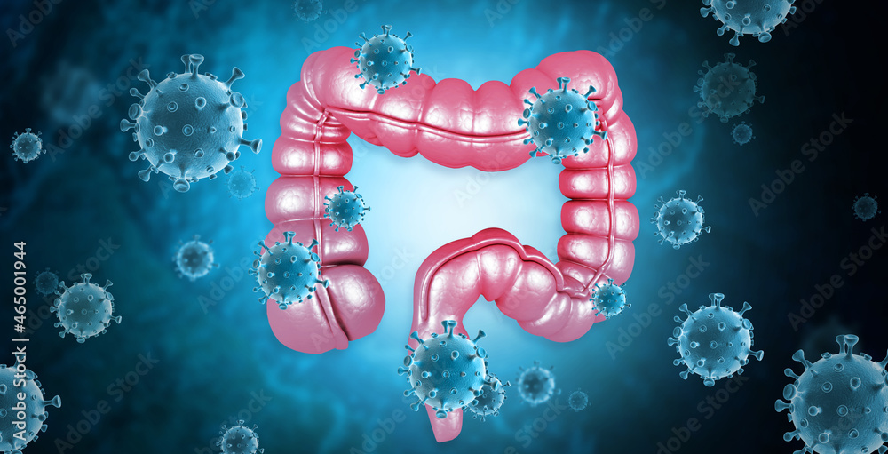 Colon cancer, viruses, bacterias in sick unhealthy intestine. Colon ...