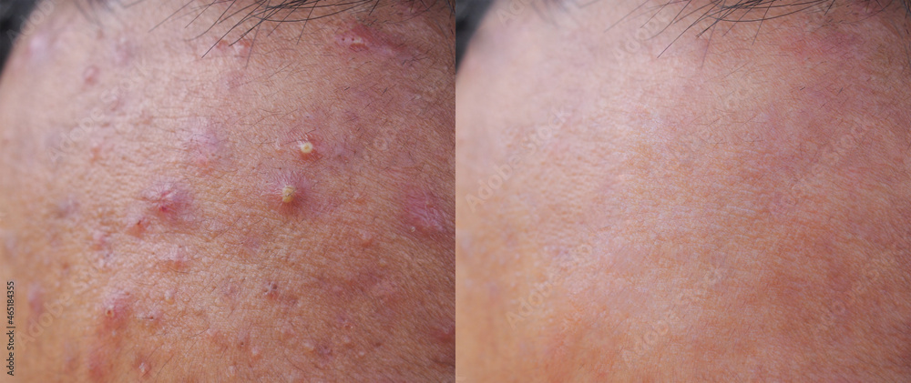 Image before and after acne treatment on the face of young Asian men ...
