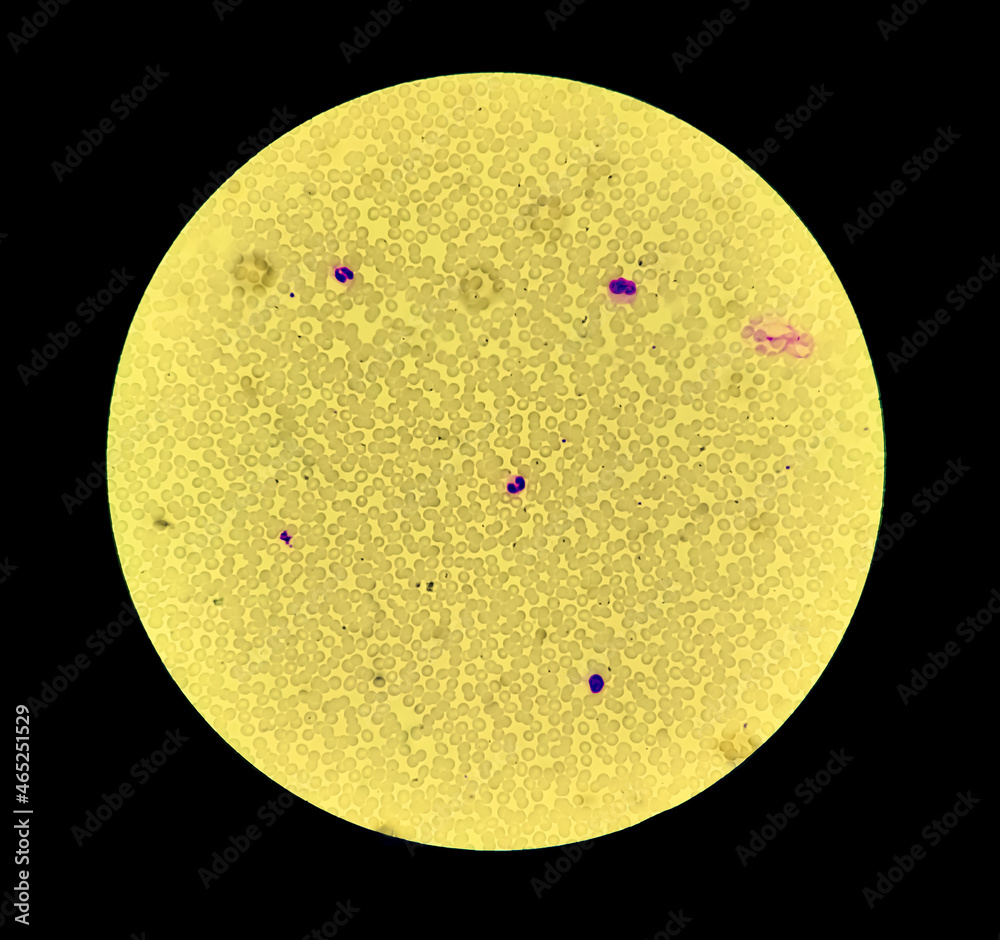 Blood smear leishman stained Microscopic show Erythroconcentration of ...