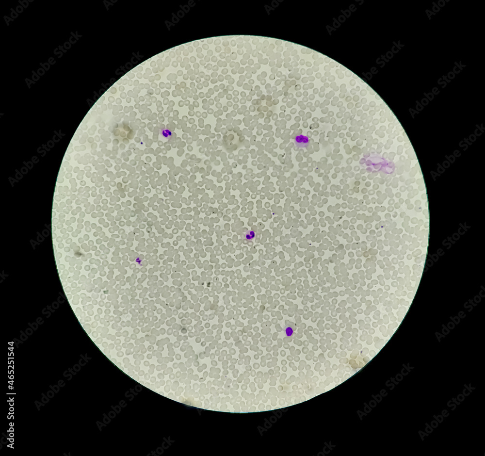 Fotka „Blood smear leishman stained Microscopic show ...