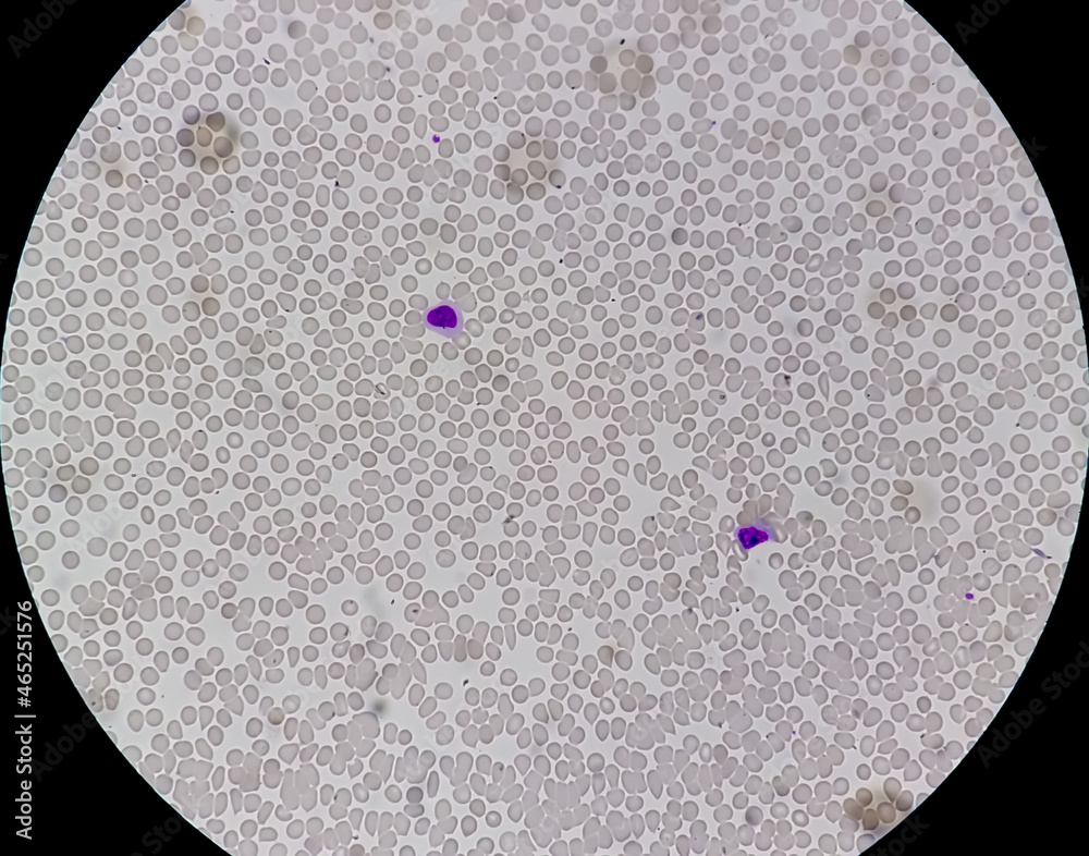 Blood smear leishman stained Microscopic show Erythroconcentration of ...