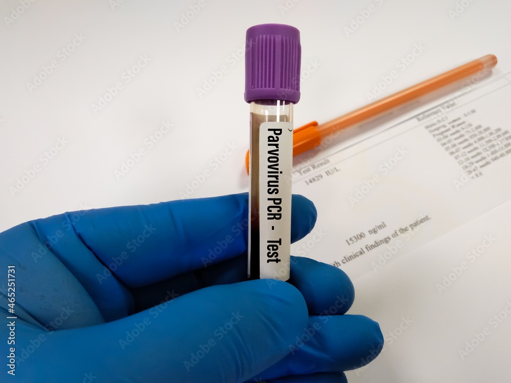 Scientist holding blood sample tube for Parvovirus PCR test at medical ...