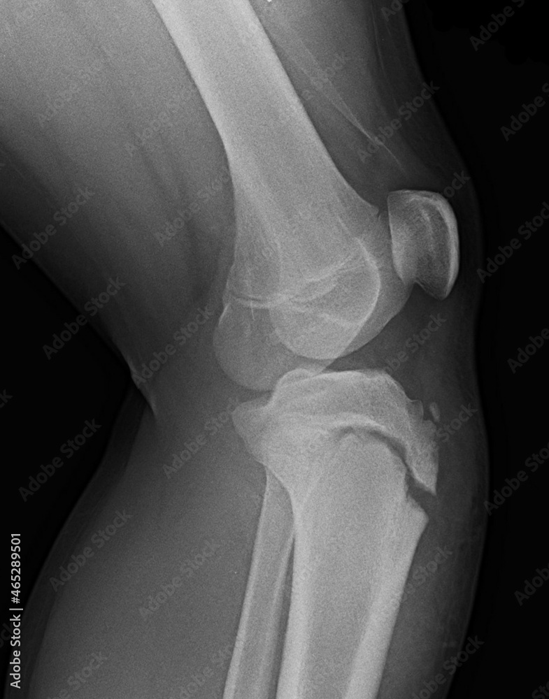 X ray image of fracture tibia.broken knee Stock Photo | Adobe Stock