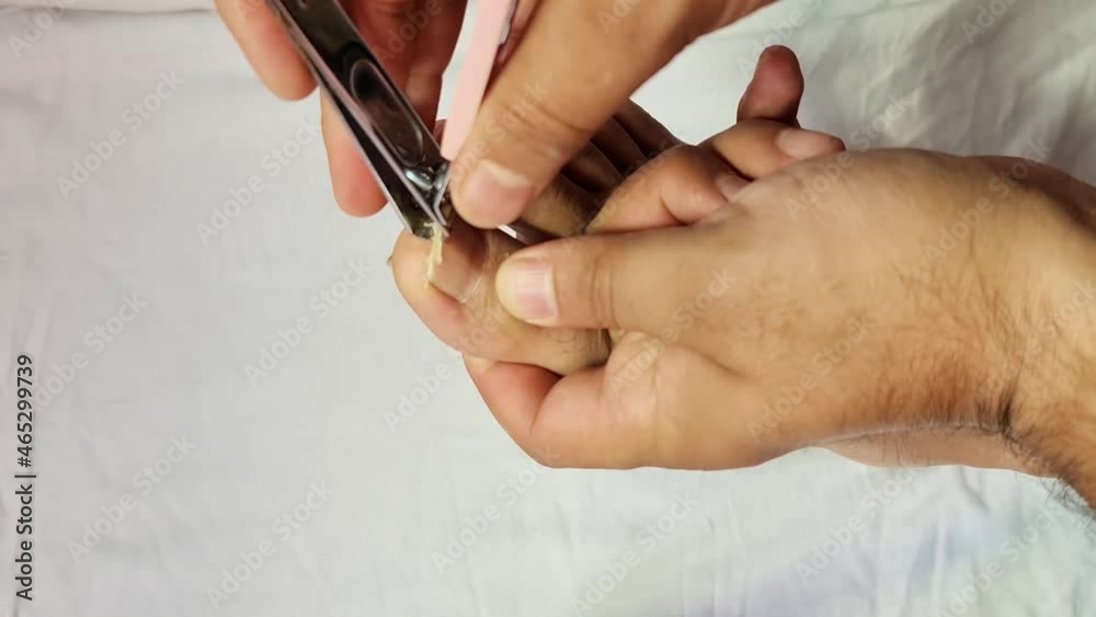 Nail cutting foot with damaged nails because of fungus. Dorsal, callus ...