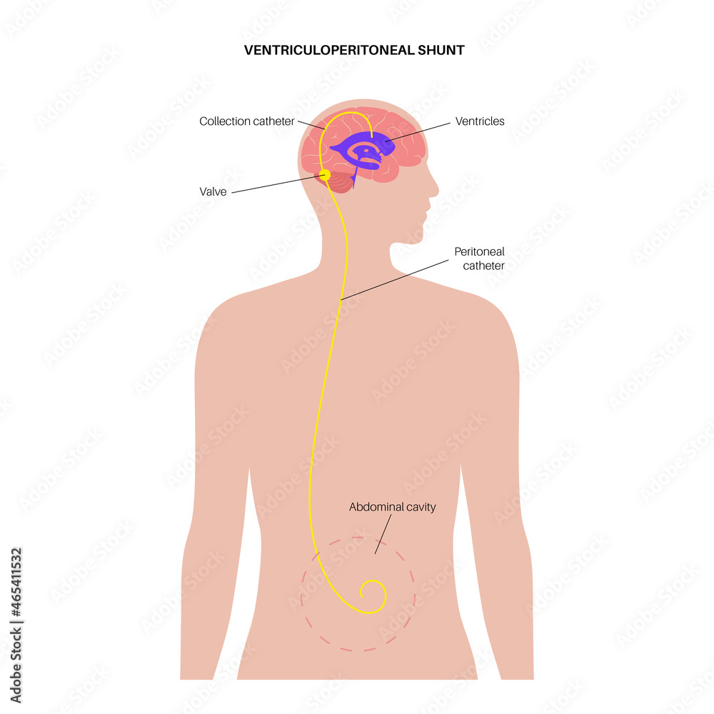 ventriculoperitoneal shunt concept Stock Vector | Adobe Stock