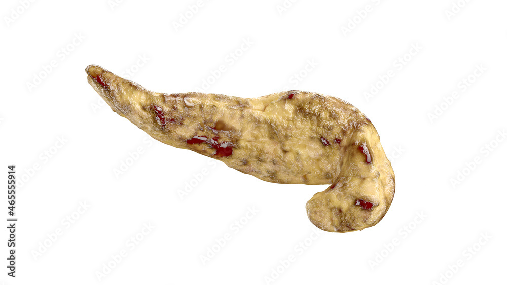 Pancreatitis disease of human pancreas isolated on white. Acute ...