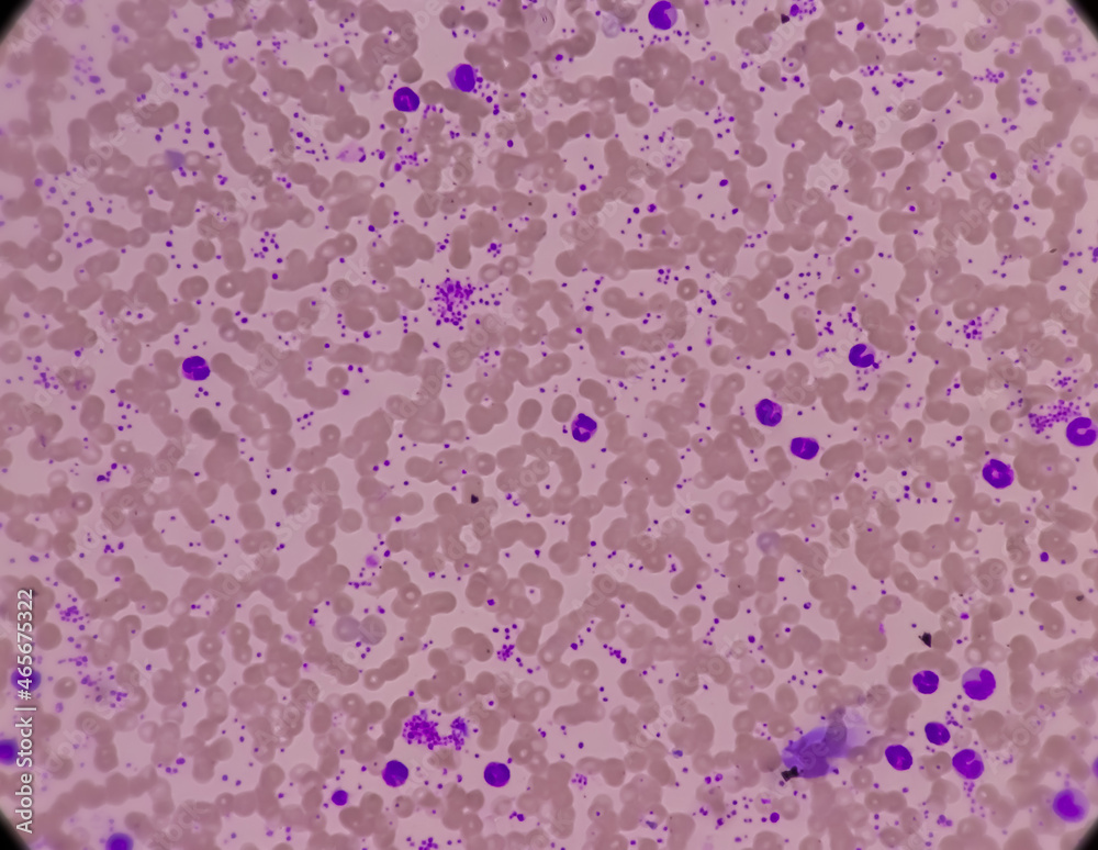 Thrombocythemia, Essential thrombocytosis blood smear, present abnormal ...