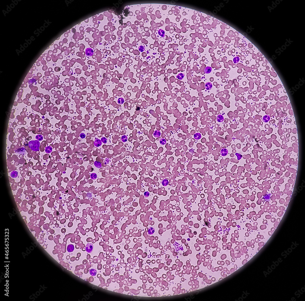 Foto de Thrombocythemia, Essential thrombocytosis blood smear, present ...