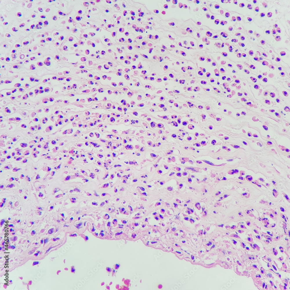 Camera photo of chorioamnionitis, showing several neutrophils in ...