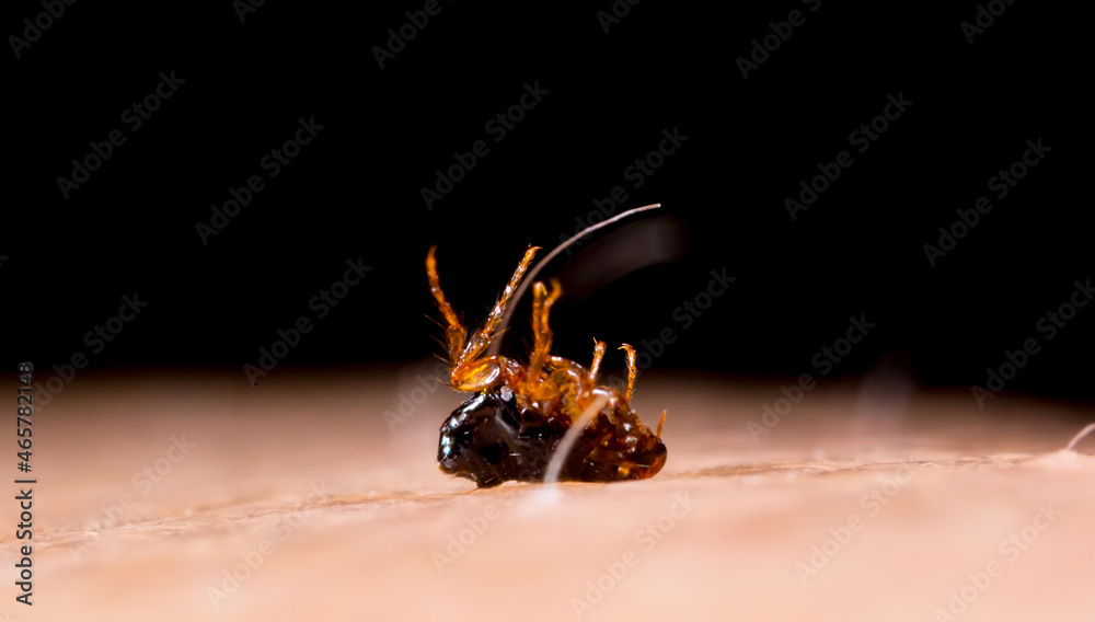 Flea on human skin close up. Extermination of parasites, insecticides ...