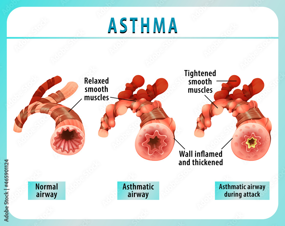 Bronchial Asthma diagram with normal airway and asthmatic airway Stock ...