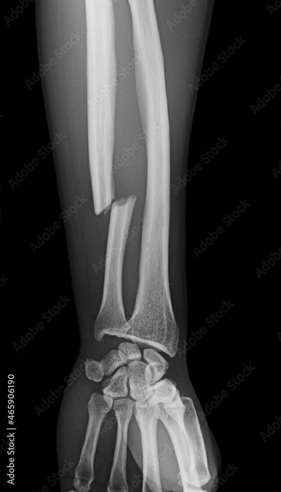x ray of a broken hand.fracture os Stock Photo | Adobe Stock
