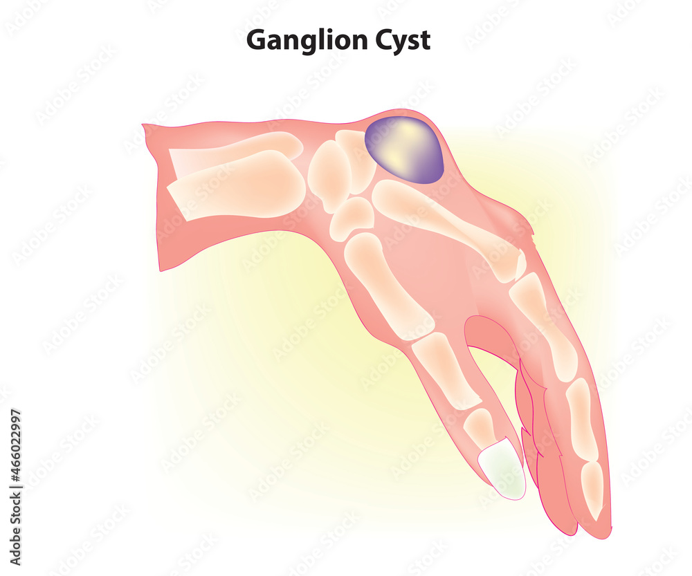 Biological illustration of ganglion cyst Stock Vector | Adobe Stock