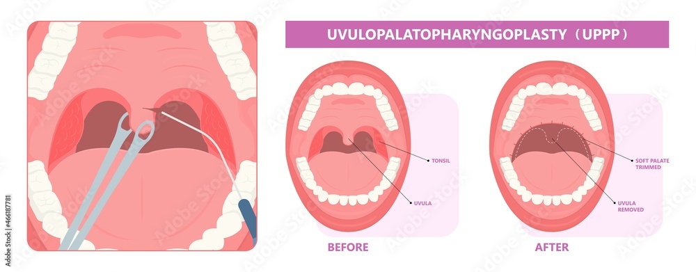 Uvula Removal
