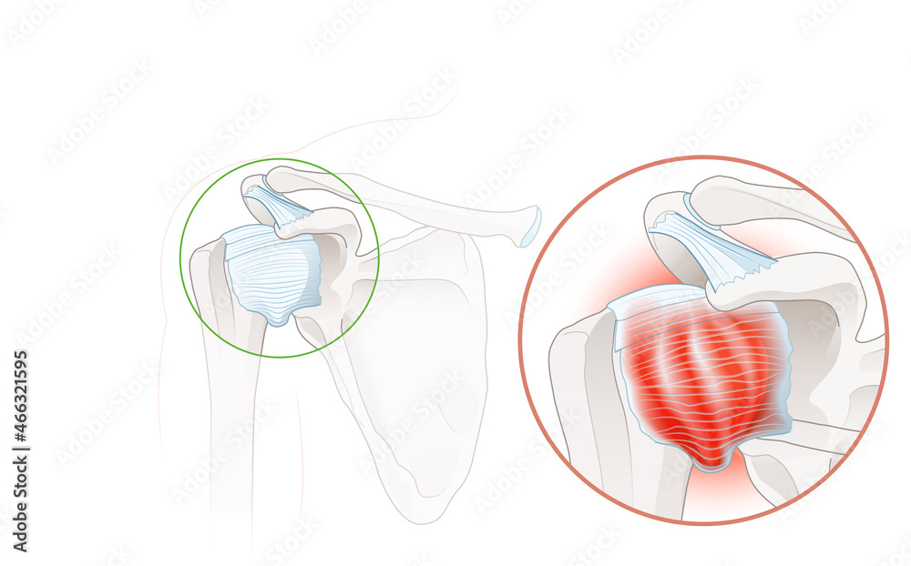 Frozen shoulder. Adhesive capsulitis surgery. Labeled Illustration ...