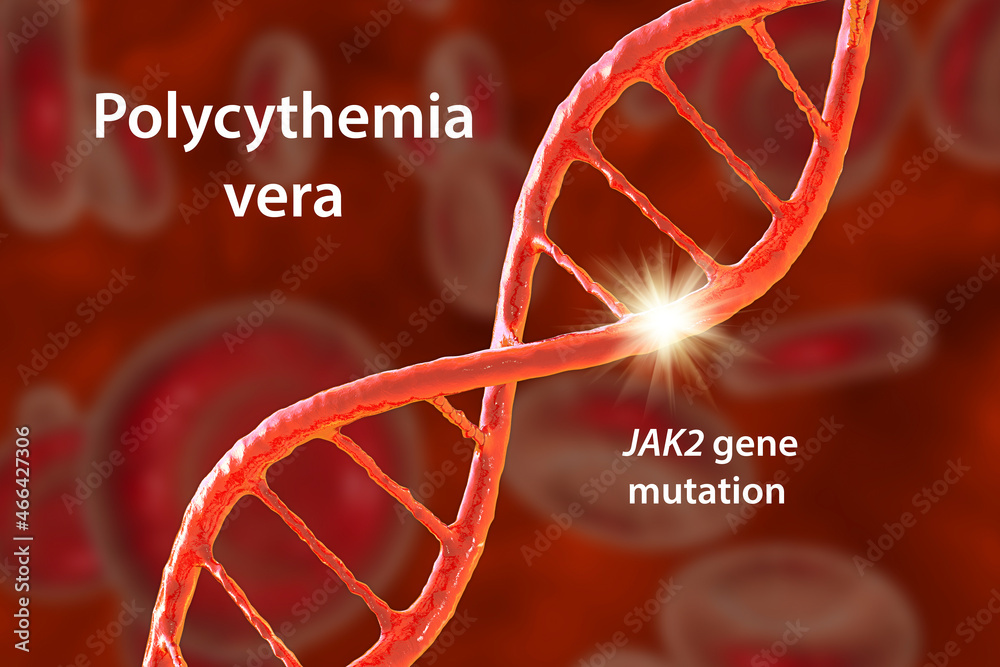 Polycythemia vera, a rare slow-growing blood cancer with an increase in ...