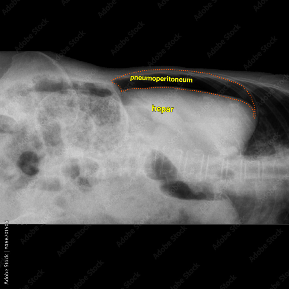 x ray of pneumoperitoneum,abdomen free air Stock Vector | Adobe Stock