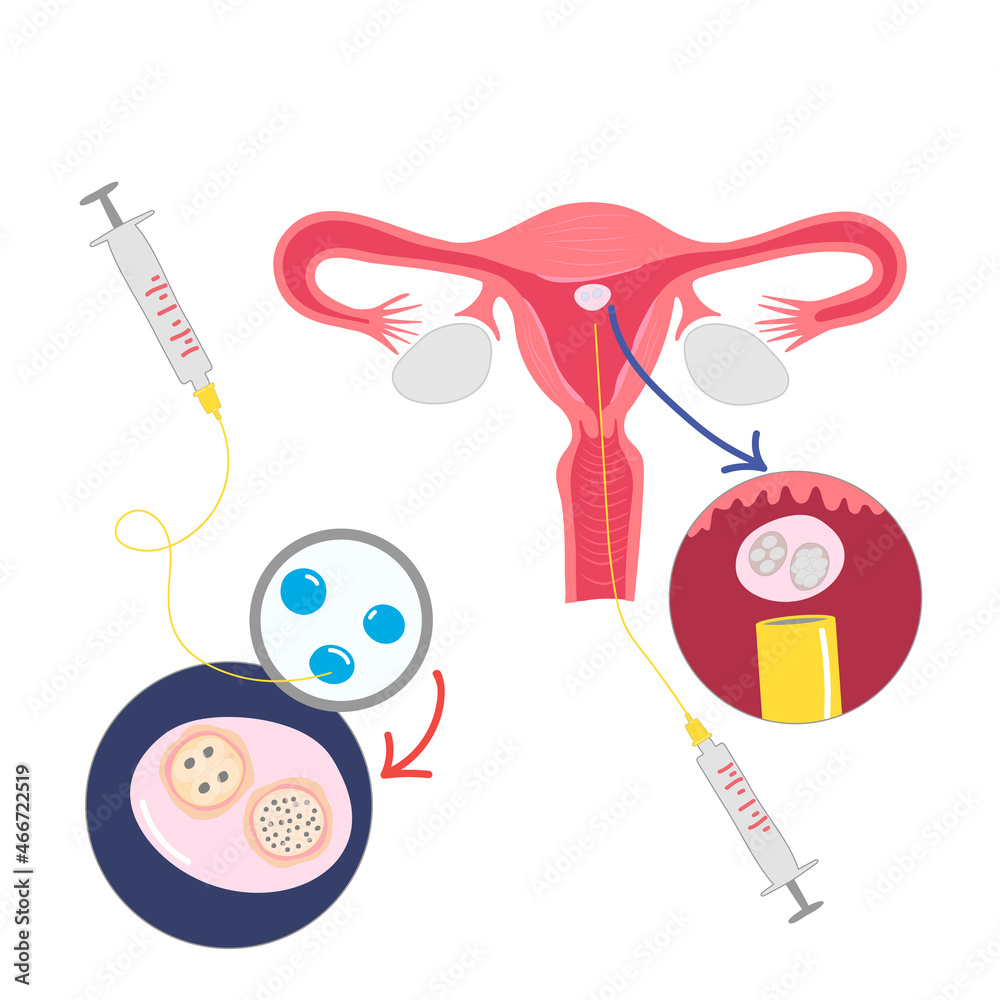 vector illustrations for gynecology. In vitro fertilization treatment ...