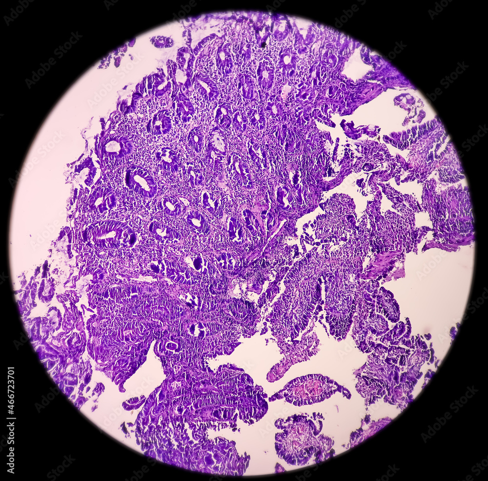 Colon Cancer: Photomicrograph (microscopic image) of colorectum ...