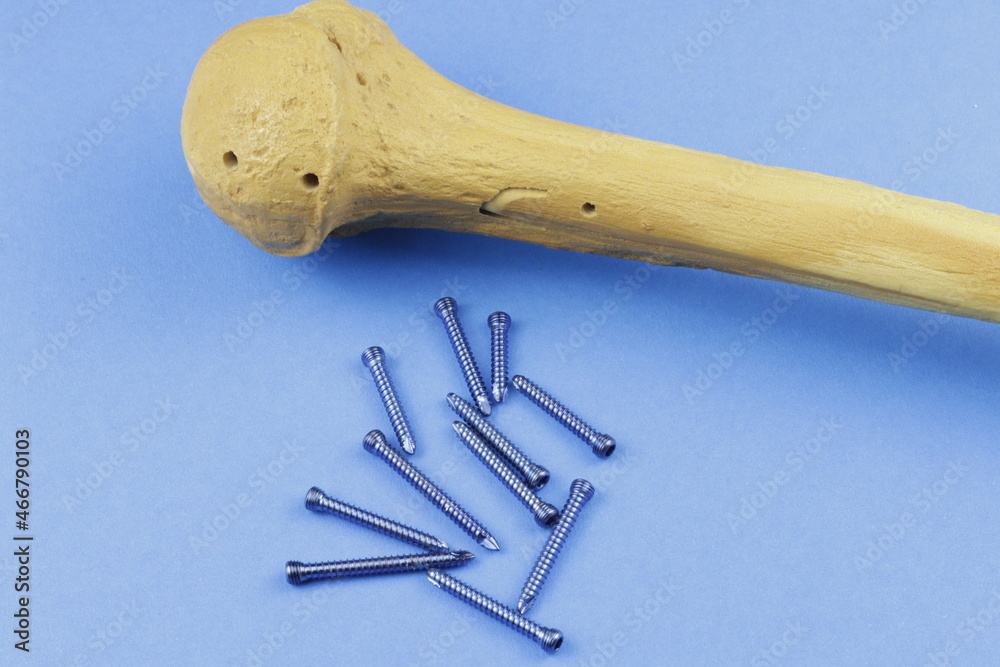 Surgical plates and instruments for osteosynthesis of bone fractures ...